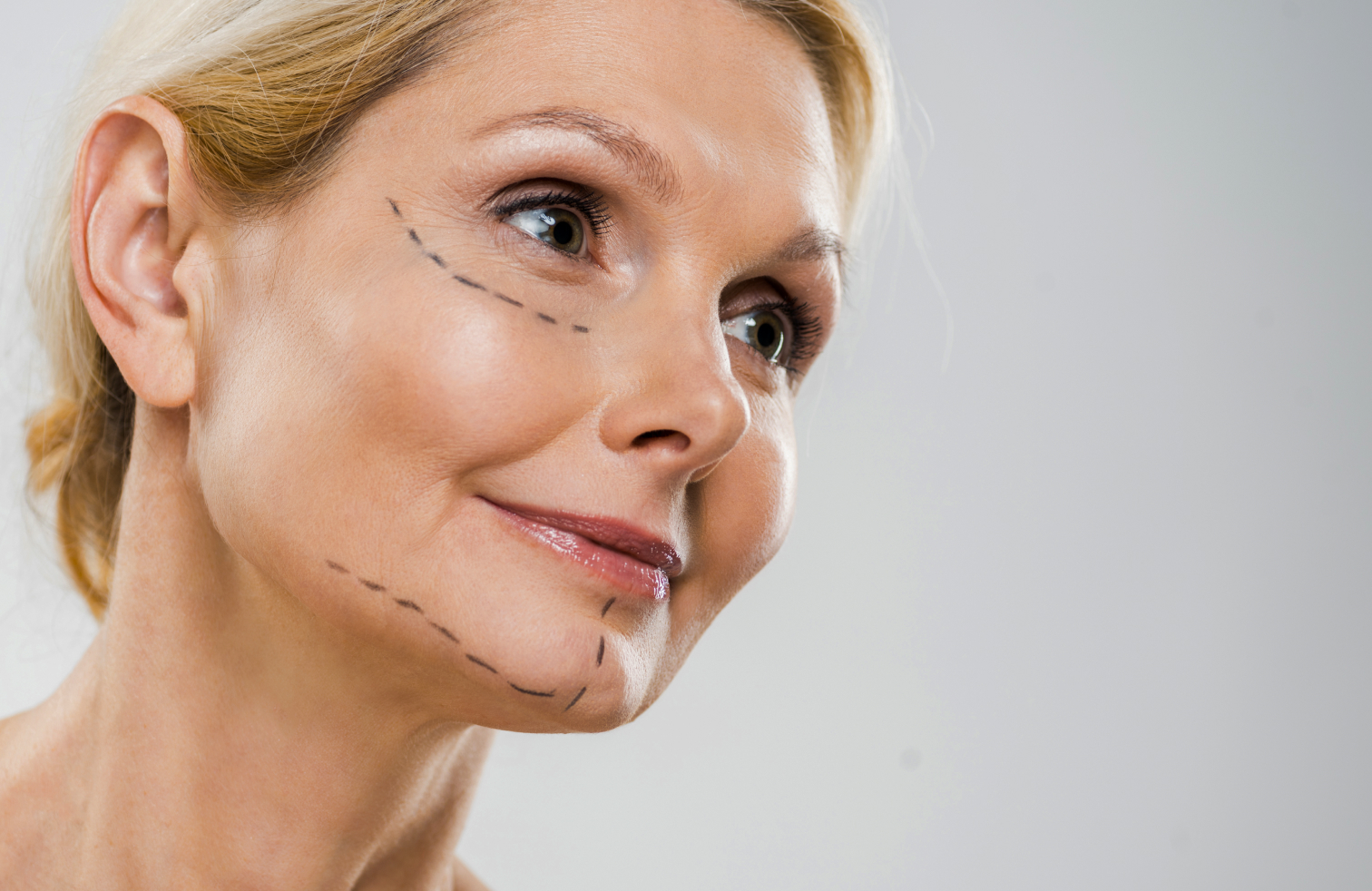 Facelift Orlando